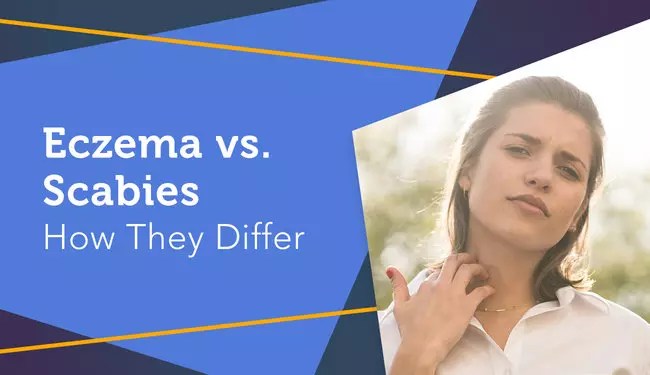eczema_vs._scabies-_how_they_differ.webp